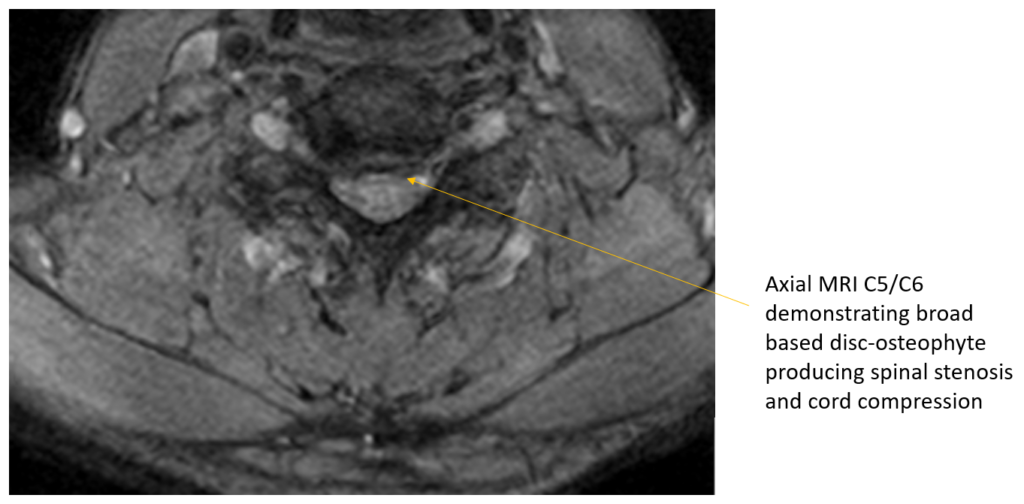 ACDF Surgery for Back Pain | Cleveland Spine Center